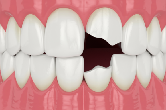 Dental Emergency? 5 Tips to Save Your Teeth Guide by Alpha Dental Clinic