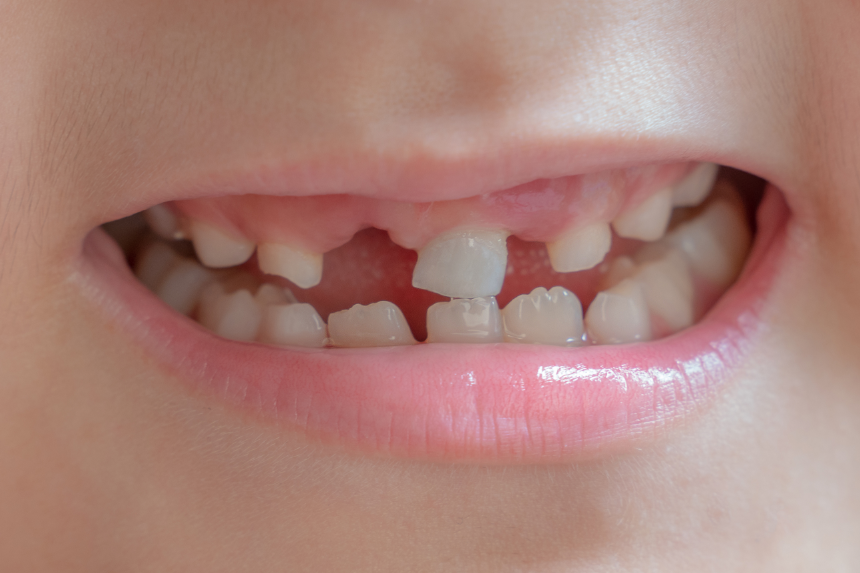 Dental Implants: Can They Be Used for Front Teeth?