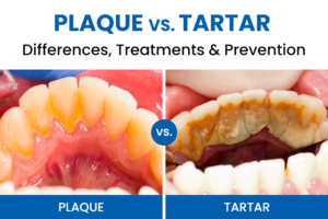 Plaque vs. Tartar: Differences, Treatments & Prevention